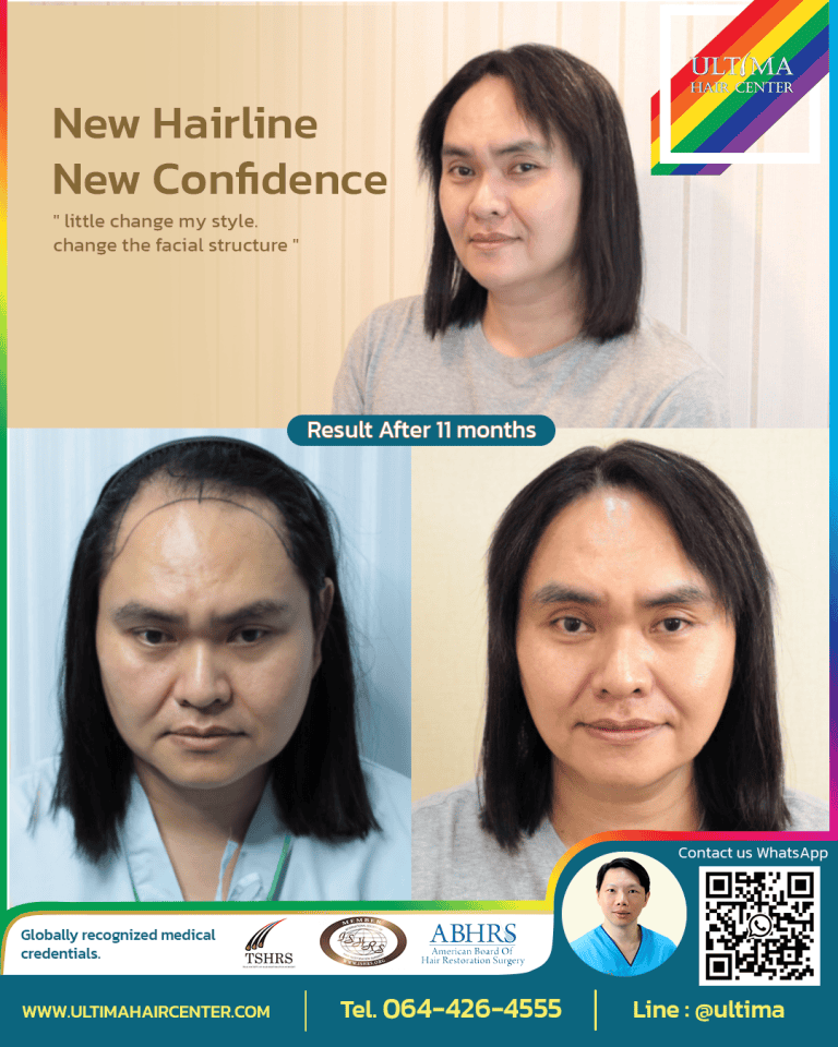 Transgender Hair Transplant - Ultima Hair Transplant Thailand