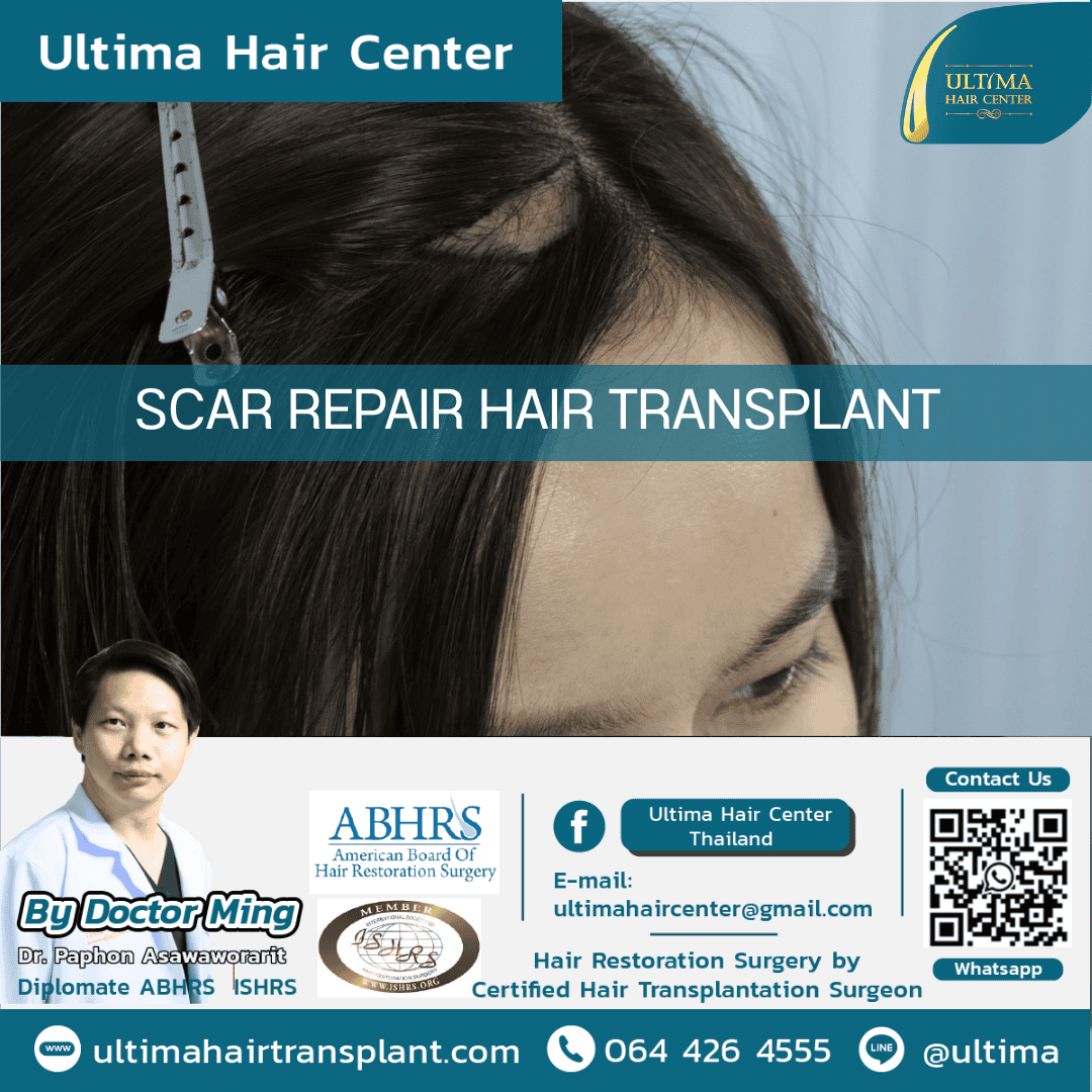 Hair Transplant Revision Repair - Ultima Hair Transplant Thailand