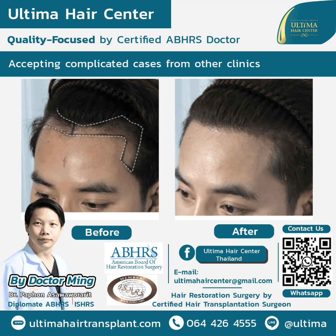 FUT Hair Transplant Bangkok