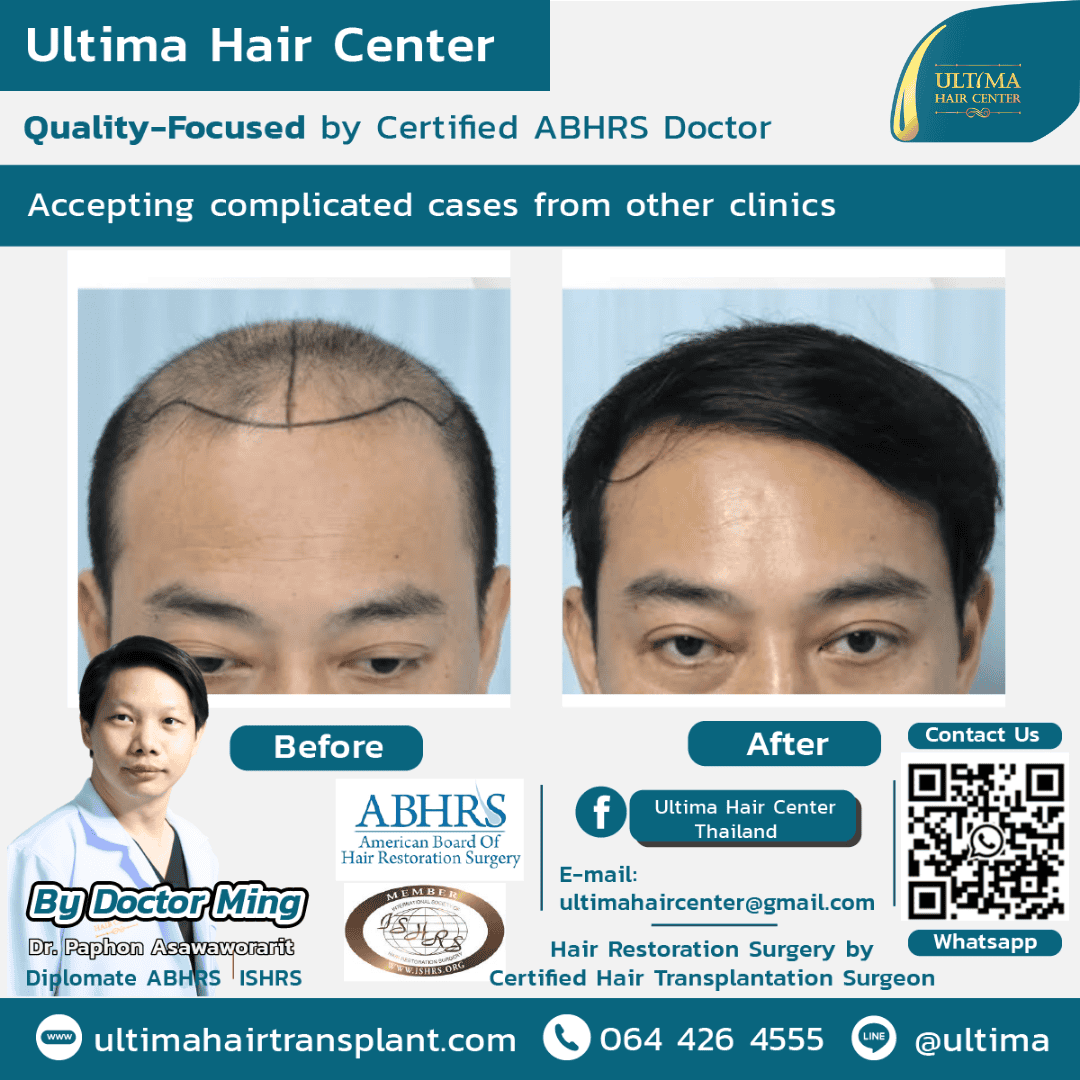 Hair loss solution Bangkok